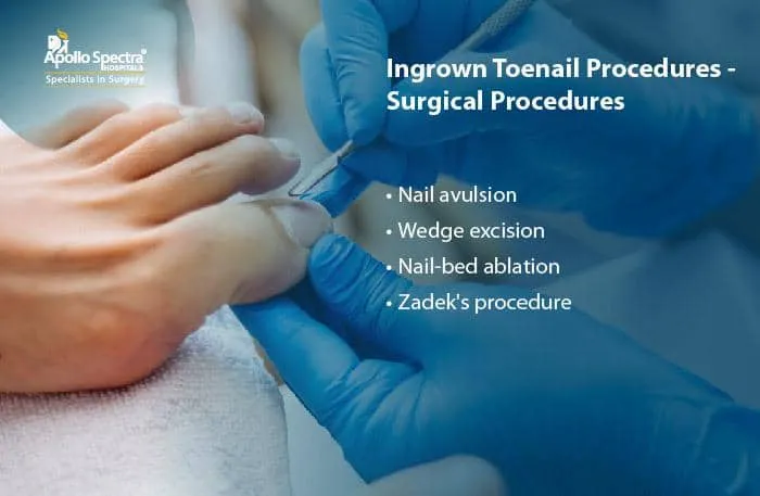 Foot & Ankle Clinic in Chennai for Ingrown Toenail Surgery